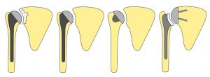 Tipos de prótesis de hombro - MBA blog