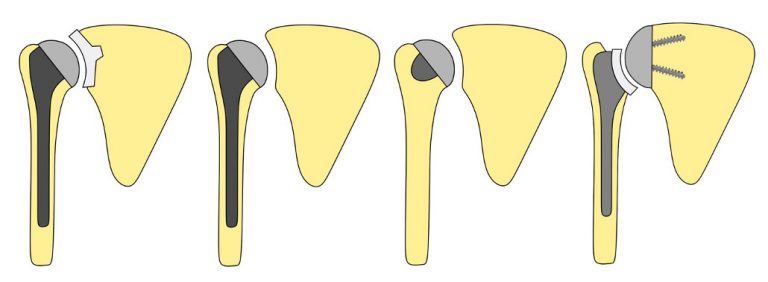 Tipos de prótesis de hombro - MBA blog