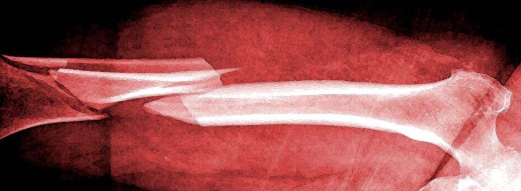 Tipos de fracturas óseas: definición y clasificación- MBA Blog