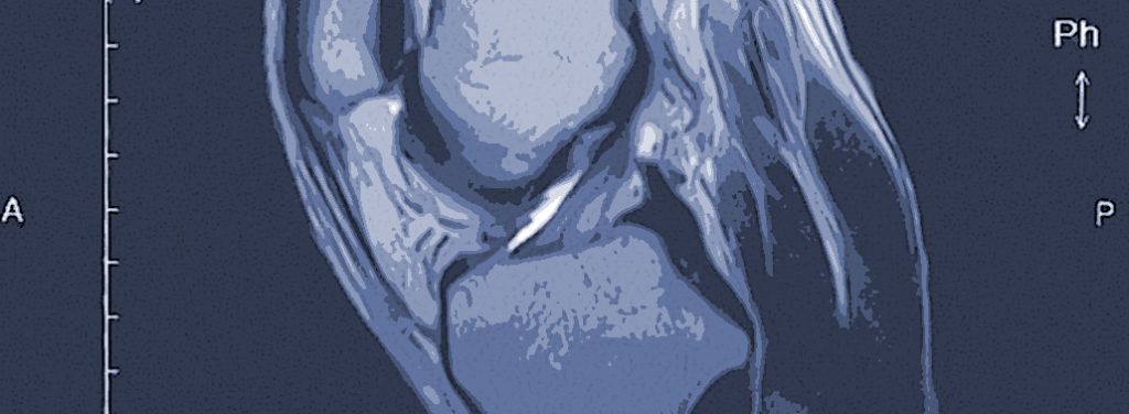 Rotura del ligamento cruzado anterior de rodilla: Entrevista