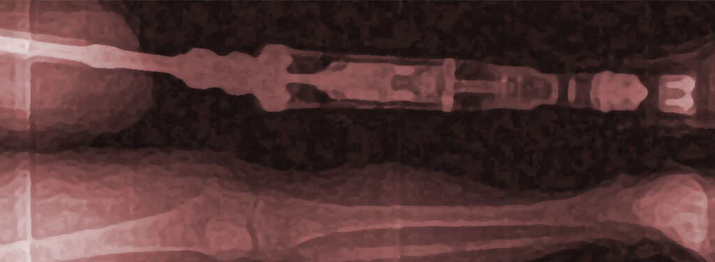 Todo lo que debes saber sobre amputaciones - MBA blog